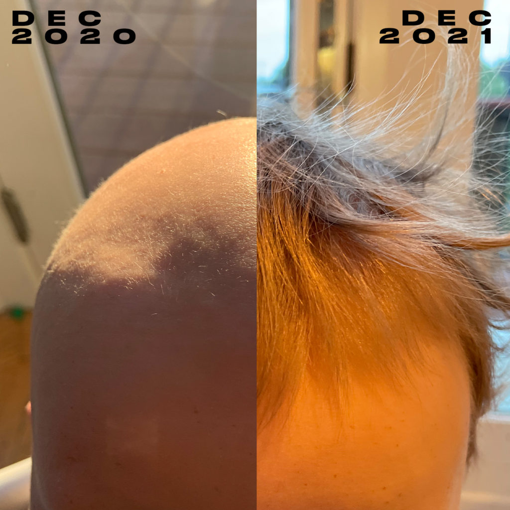 Alopecia & Mold: A Young Girl’s Story of Recovery - CTA